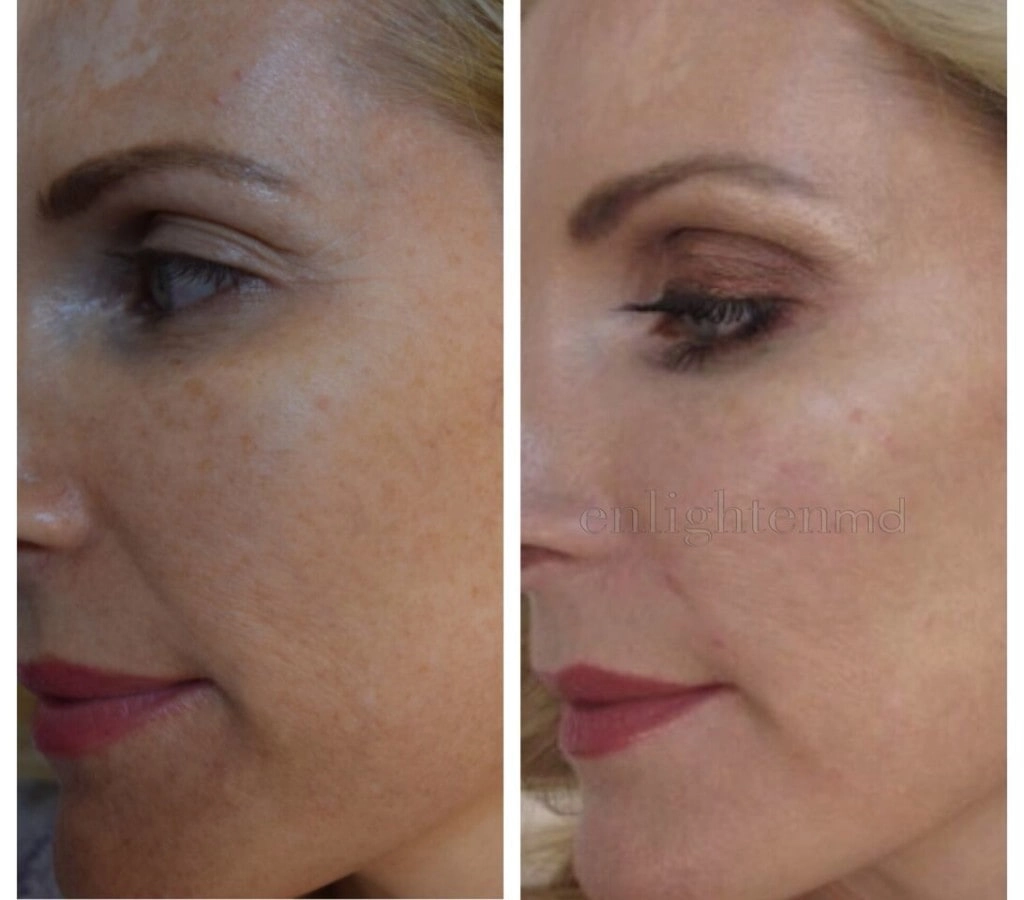 PHOTO FACIAL REVEAL - IT TOOK YEARS OF SUN DAMAGE OFF MY SKIN - So ...